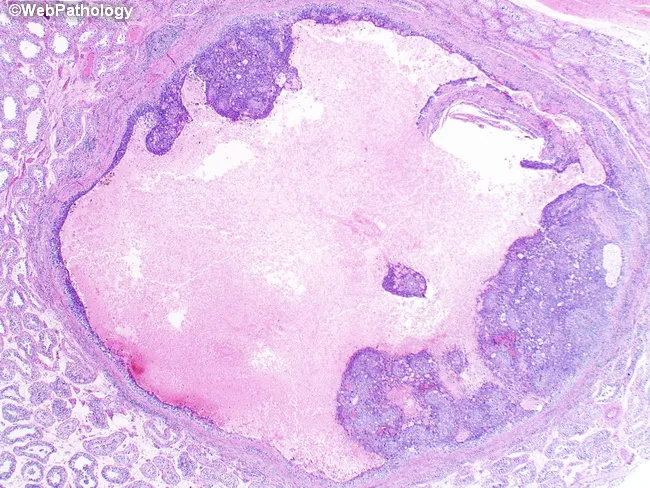 Embryonal CA : Macrocysts