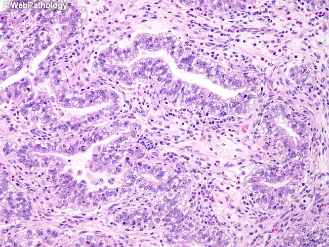 Embryonal CA : Secretory change