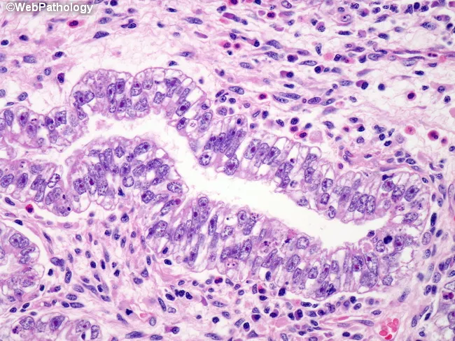 Embryonal CA : Secretory change