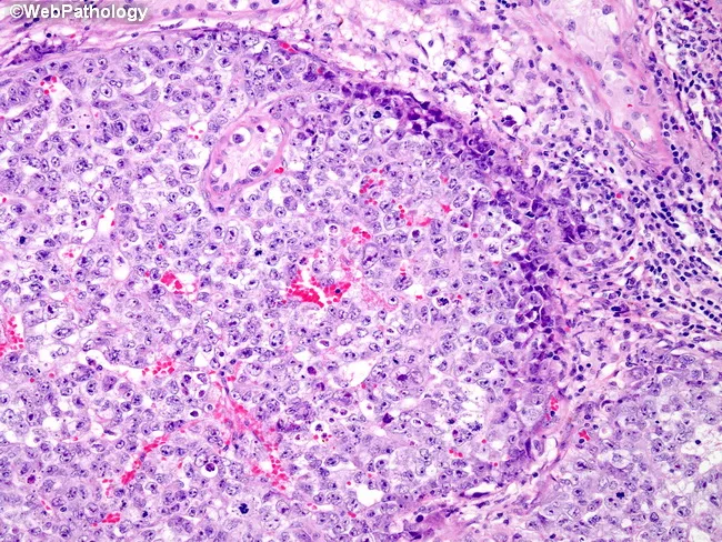 Embryonal CA : Applique appearance