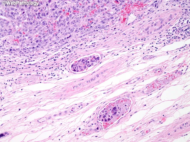 Embryonal CA : Lympho-vascular Invasion