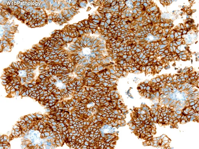 Embryonal CA : CD30 Immunostain