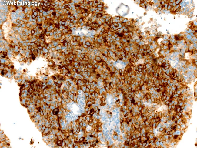 Embryonal CA : PLAP Immunostain