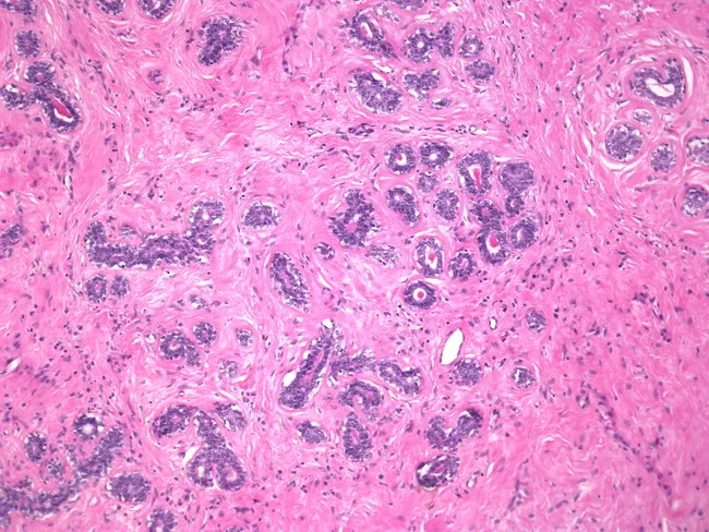 Fibroadenoma : Pericanalicular