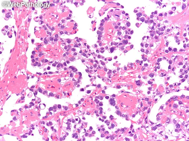 Yolk Sac Tumor : Endodermal Sinus Pattern
