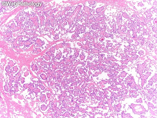 Yolk Sac Tumor : Endodermal Sinus Pattern