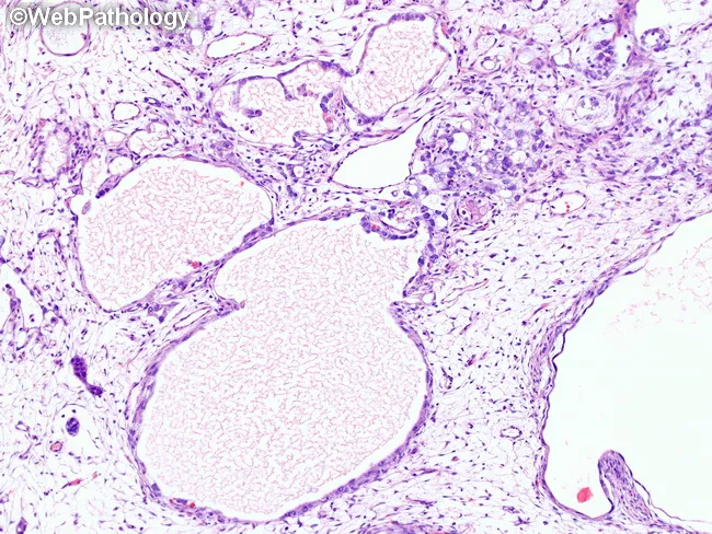 Yolk Sac Tumor : Polyvesicular Vitelline