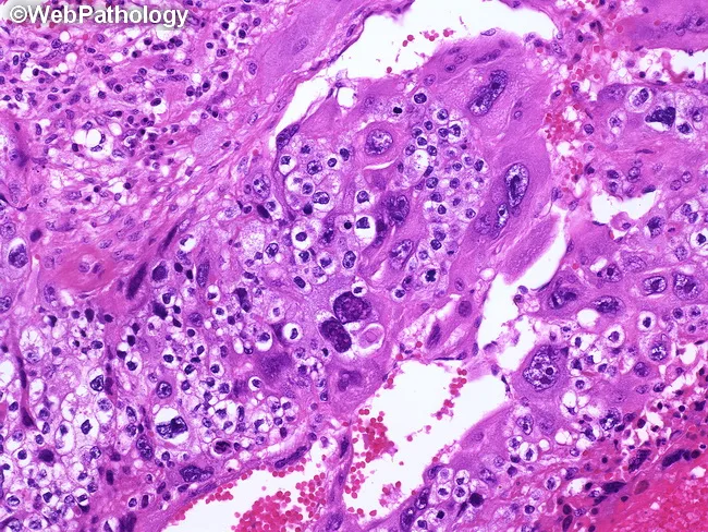 Choriocarcinoma : Prognosis