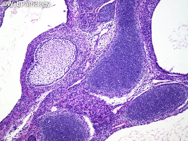 Post-pubertal Teratoma