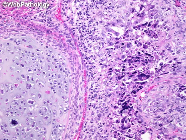 Post-pubertal Teratoma