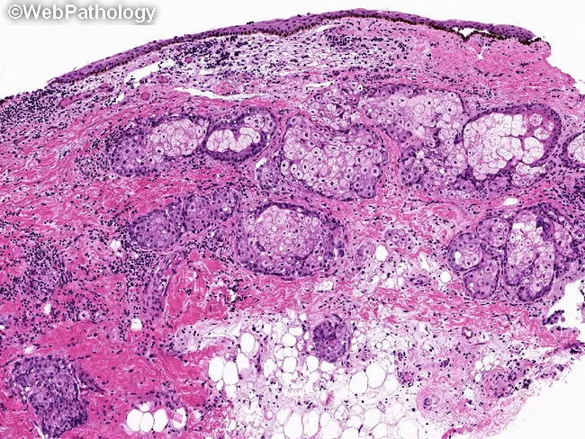 Prepubertal-type Teratoma : Dermoid Cyst