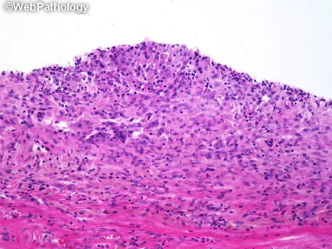 Prepubertal-type Teratoma : Dermoid Cyst