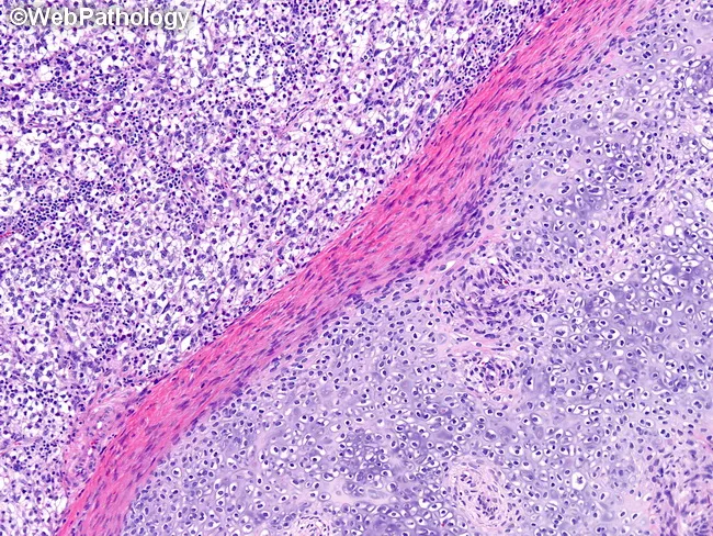 Mixed Germ Cell Tumor : Prognosis