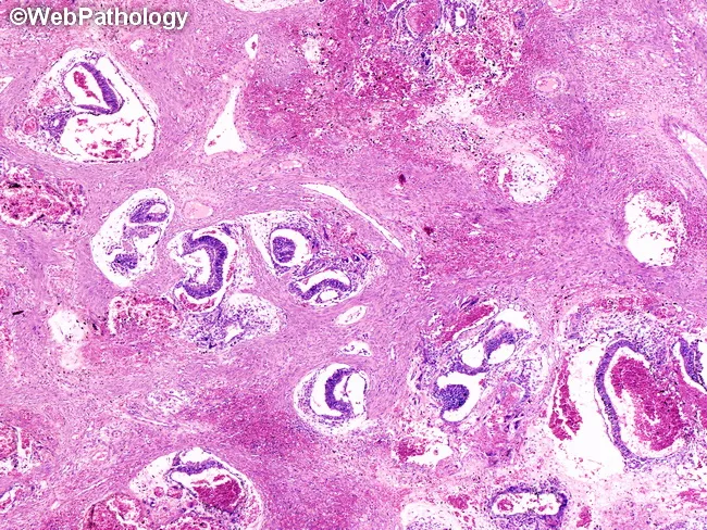 Mixed Germ Cell Tumor : Polyembryoma