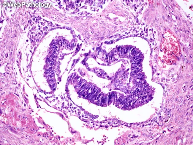 Mixed Germ Cell Tumor : Polyembryoma
