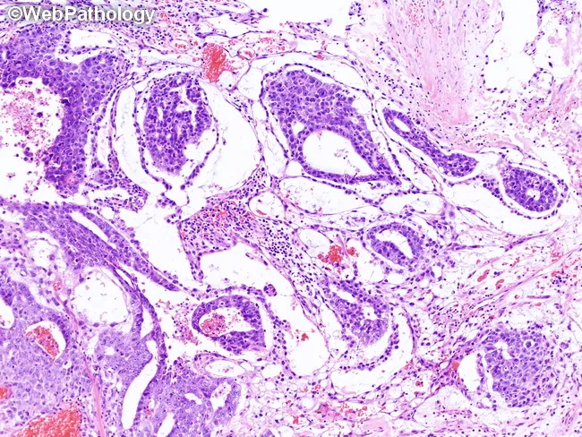 Mixed Germ Cell Tumor : Diffuse Embryoma