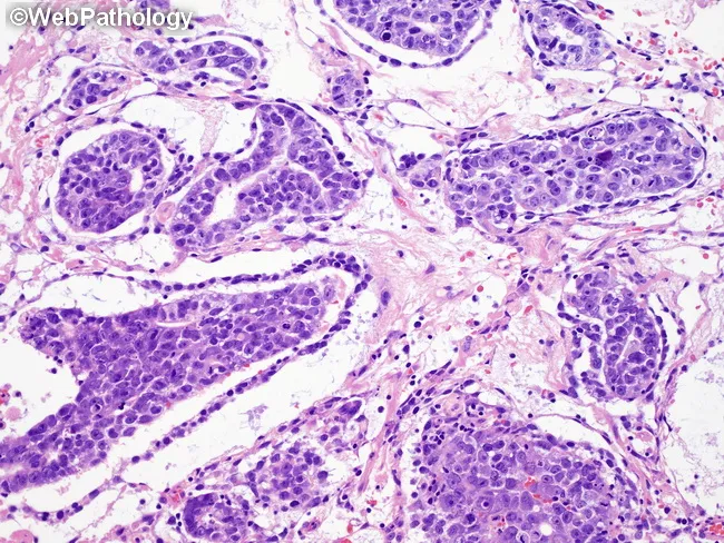 Mixed Germ Cell Tumor : Diffuse Embryoma