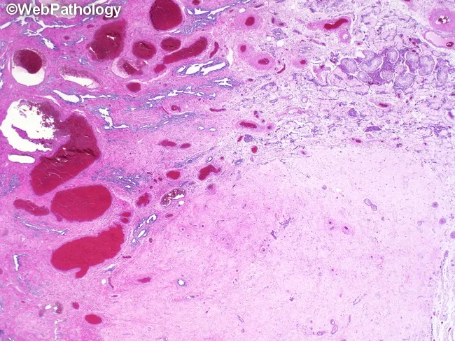 Regressed Germ Cell Tumor Intro 7984