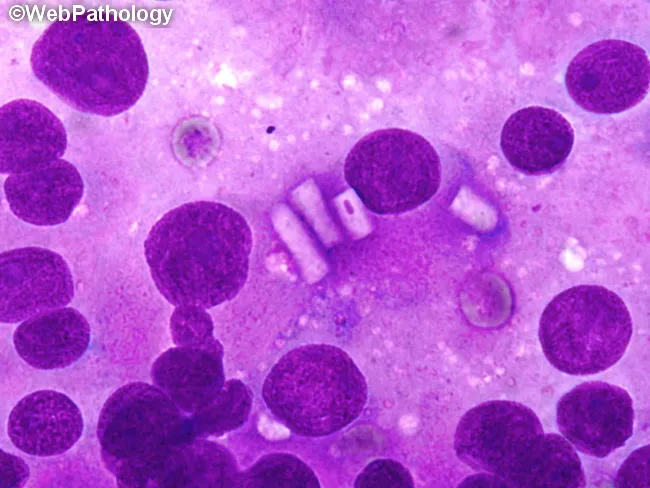 Leydig Cell Tumor : Reinke's Crystalloids
