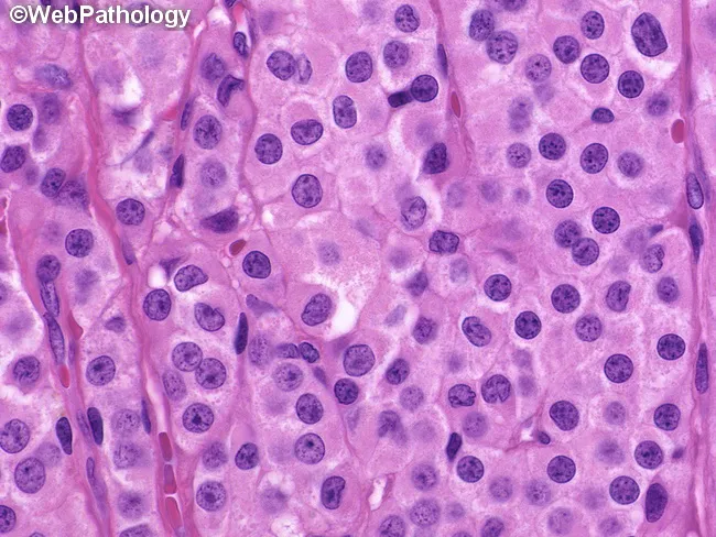 Leydig Cell Tumor : Microsopic