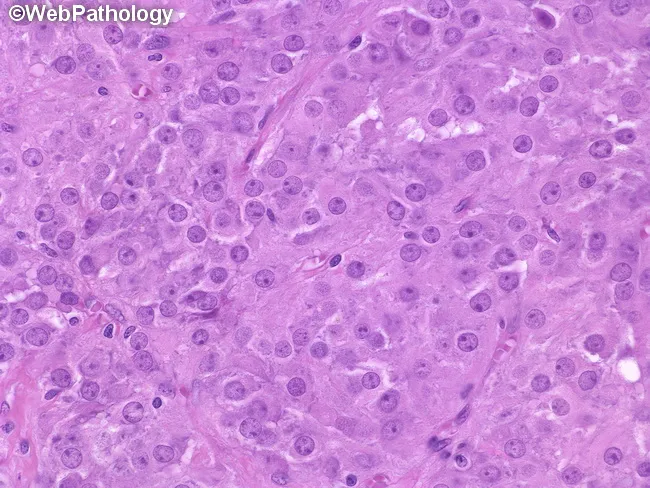 Leydig Cell Tumor : Differential Diagnosis