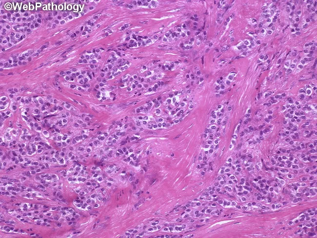 Leydig Cell Tumor : Treatment