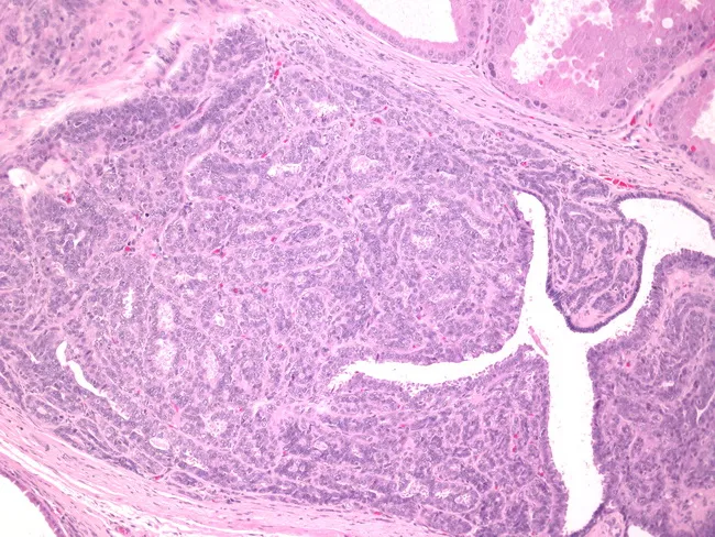 Intraductal Papilloma of Breast : Solid type