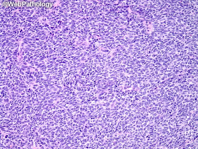 Adult Granulosa Cell Tumor : Microscopic