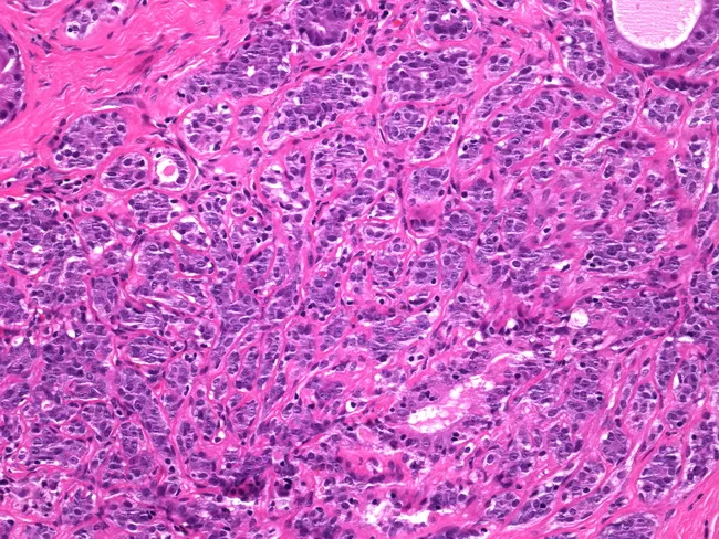 Sclerosing Adenosis of Breast