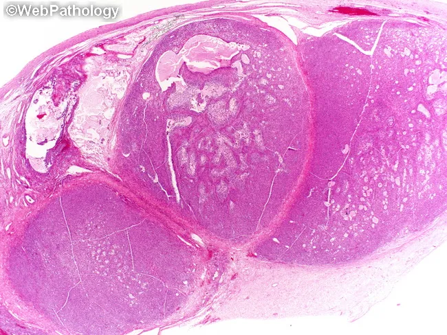 Juvenile Granulosa Cell Tumor : Intro & Clinical