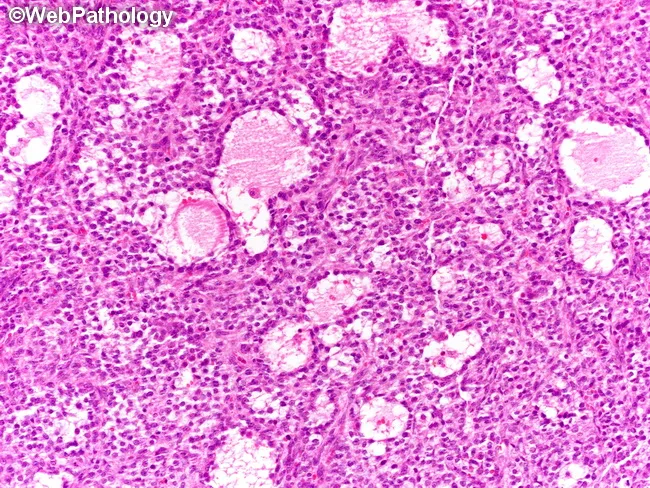 Juvenile Granulosa Cell Tumor : Immunostains