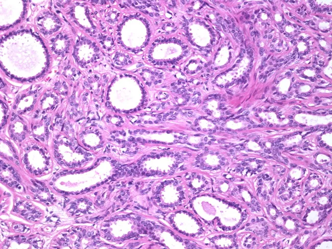 Sclerosing Adenosis Of Breast