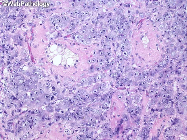 Metastatic Tumors in Testis : Microscopic