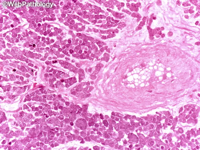 Testis : Metastatic Merkel Cell Carcinoma