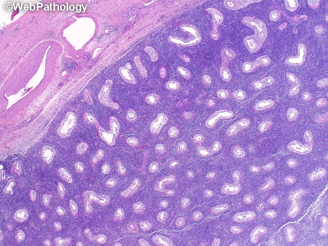 Testicular Lymphoma : Microscopic