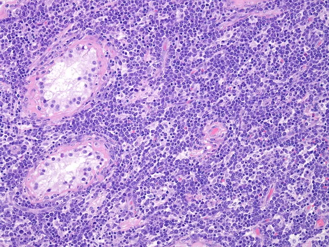 Testicular Lymphoma : Microscopic