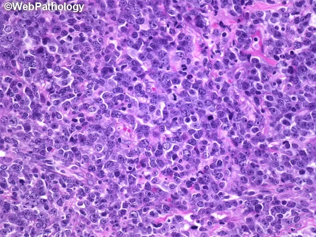 Testicular Lymphoma : Microscopic