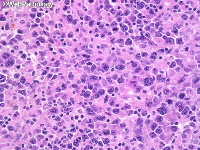 Testicular Lymphoma : Differential