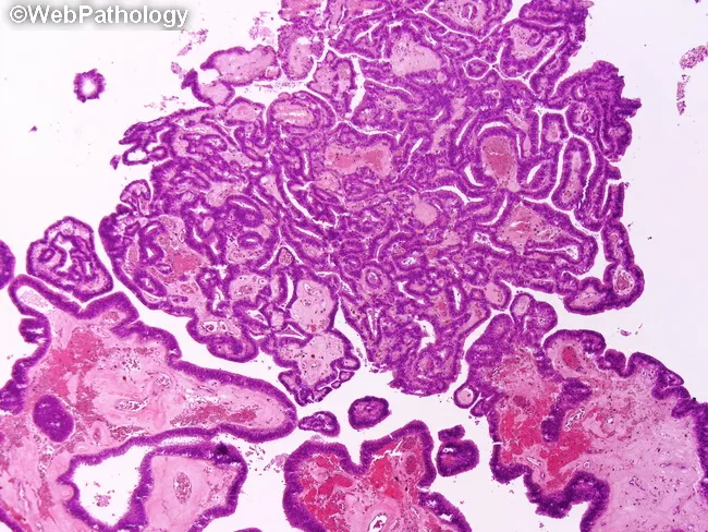 Papillary Cystadenoma of Rete Testis