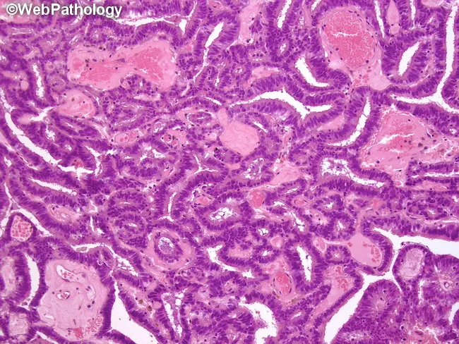 Papillary Cystadenoma of Rete Testis