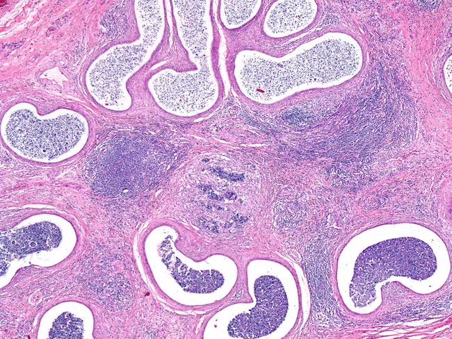 Chronic Epididymitis