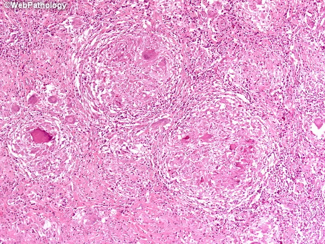 Tuberculous Epididymitis