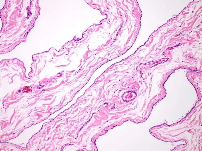 Spermatocele Histology Adenomatoid Tumors Of The Scrotum | Radiology