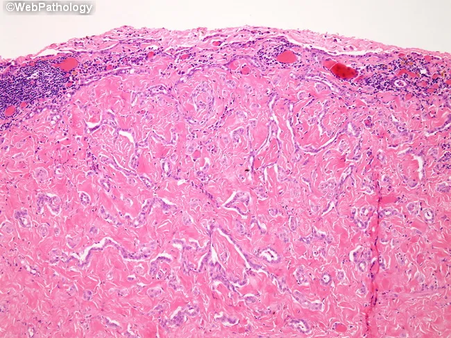 Hydrocele : Mesothelial Hyperplasia