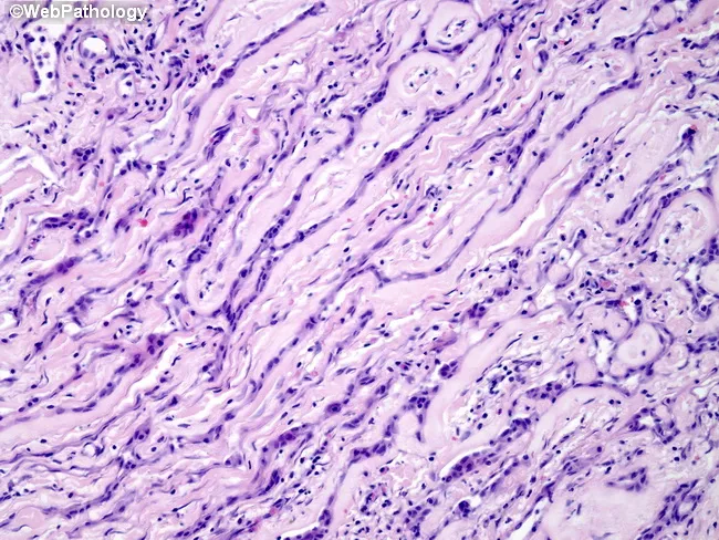 Adenomatoid Tumor