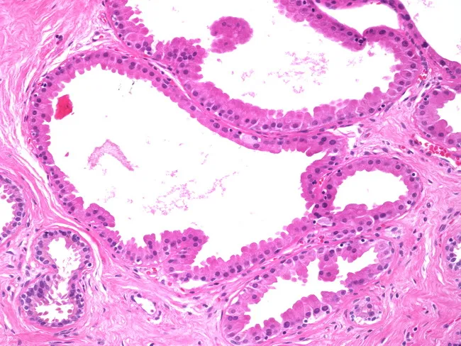Fibrocystic Change : Apocrine metaplasia