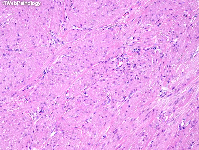 Smooth Muscle Hyperplasia of Testicular Adnexa