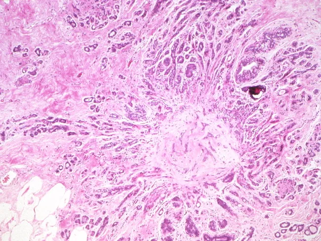 Radial Scar