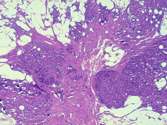 Radial Scar