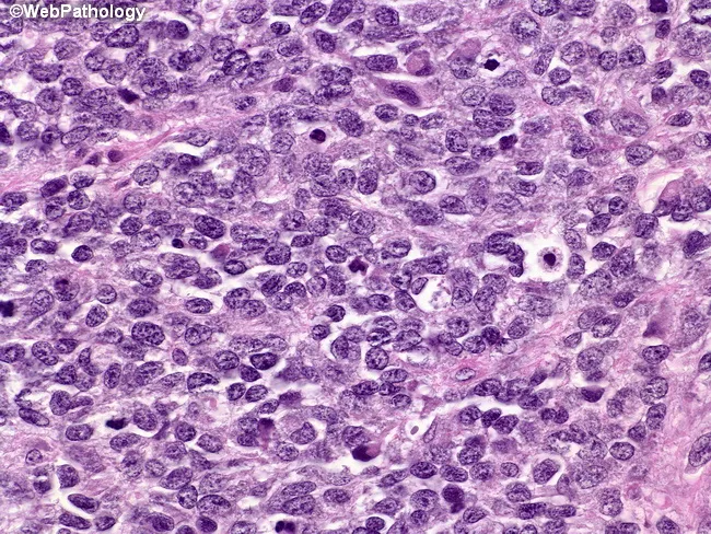 Embryonal Rhabdomyosarcoma